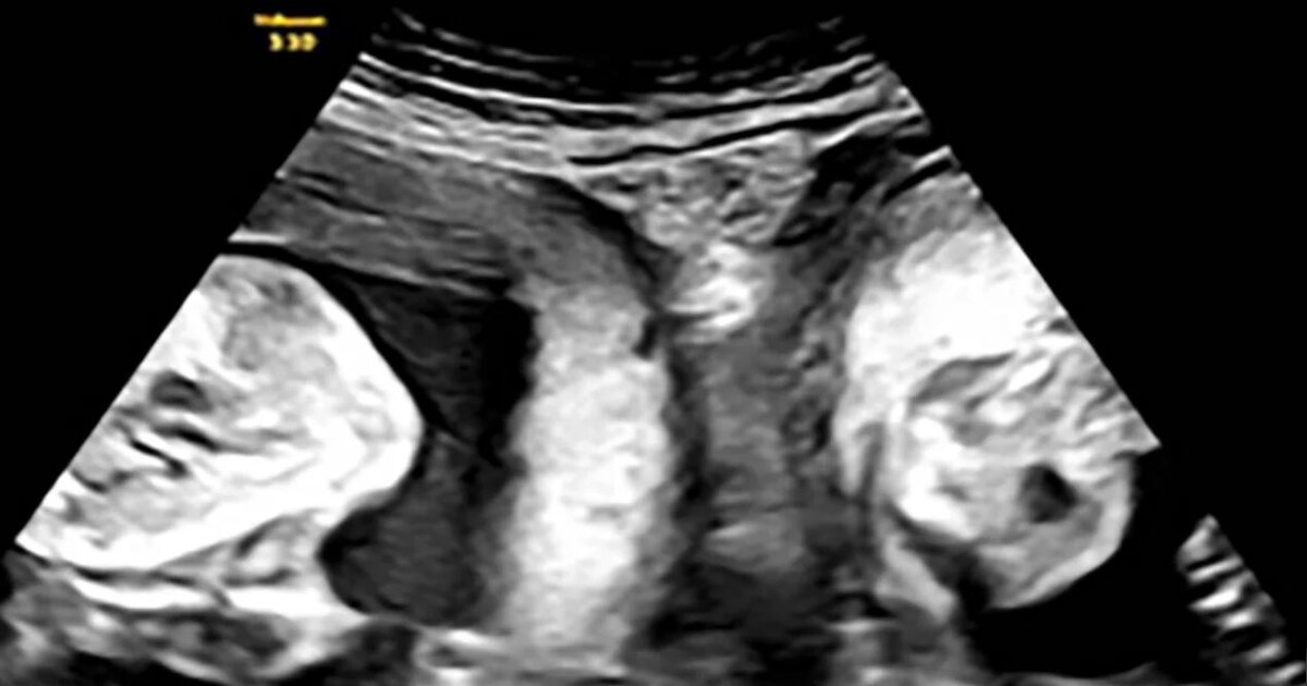 Chinese vrouw met twee baarmoeders bevalt van tweeling, een baby uit ...