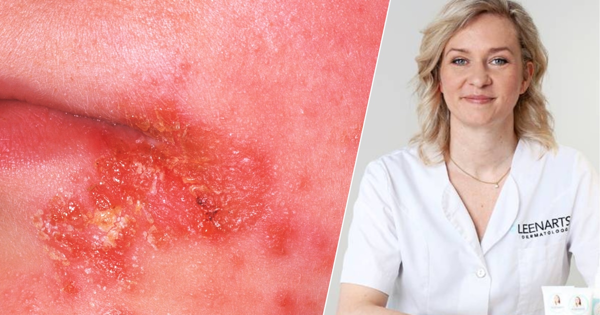 Wat is krentenbaard? Dermatoloog legt uit: ‘De een is er vatbaarder voor dan de ander’ | Gezond ...